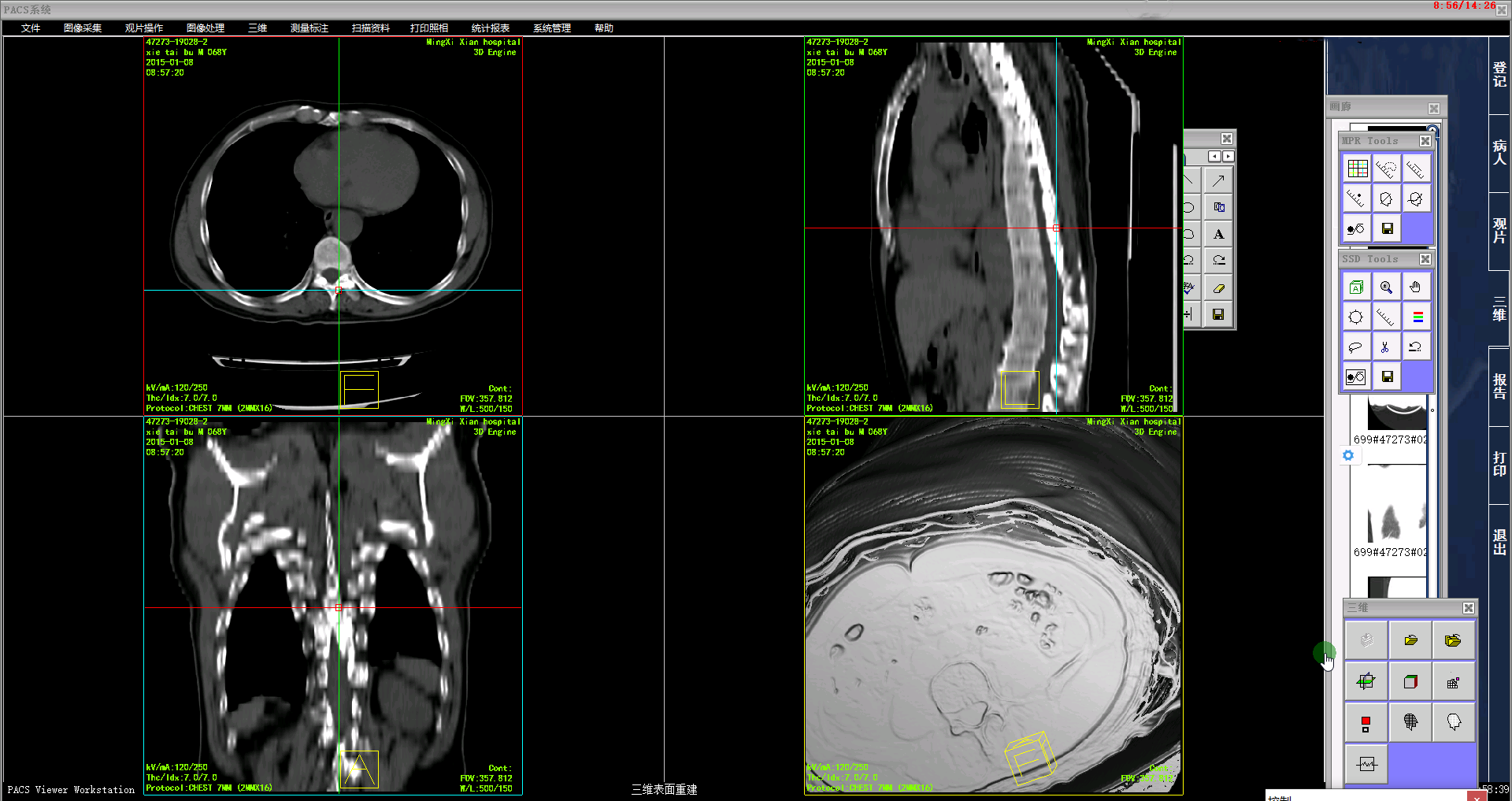 医院PACS系统源码：CT后处理技术之仿真内镜CTVE-阿里云开发者社区