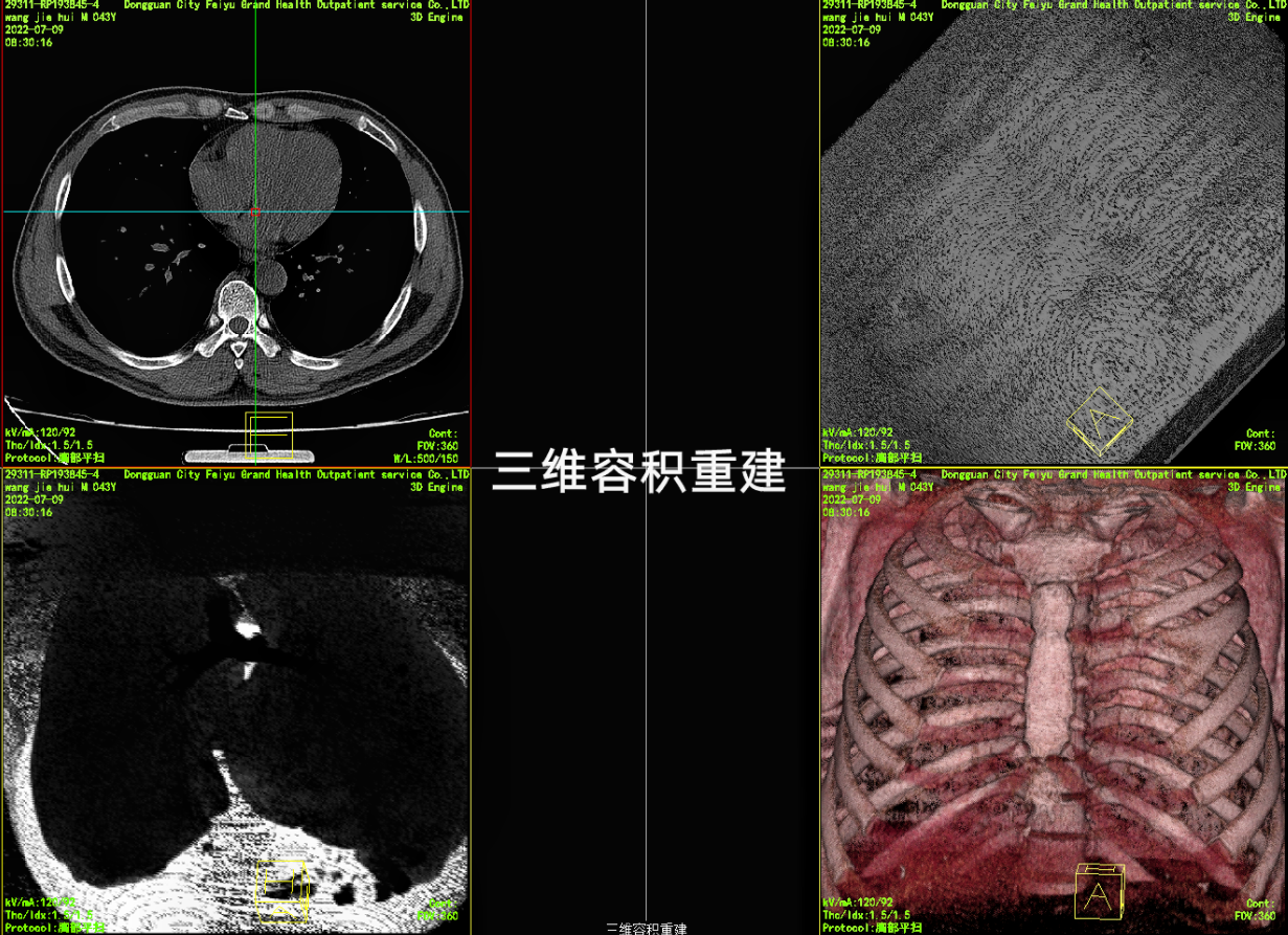 【C++医学影像PACS】CT检查中的三维重建是什么检查？-阿里云开发者社区